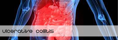 6 Best Homeopathic Medicines for Ulcerative Colitis Treatment
