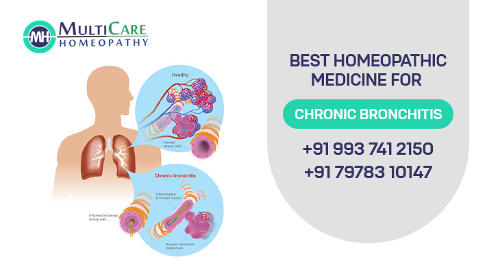 Homeopathic Medicines for Chronic Bronchitis Treatment